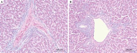 Lesions In The Liver Of Mixed Sex Broilers Fed Rations Supplemented