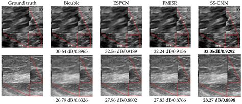 Super Resolution Ultrasound Imaging Scheme Based On A Symmetric Series Convolutional Neural Network