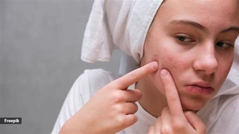 Are Pimple Patches The Ultimate Acne Solution Dermatologists Answer Life Style News The