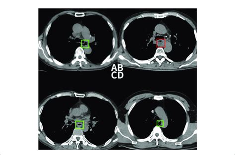 A This Case Was Detected Correctly By The Deep Learning Based Download Scientific Diagram