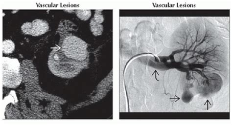 Da15 Db1 Renal Sinus Lesion Ffu5  Abdominal Key