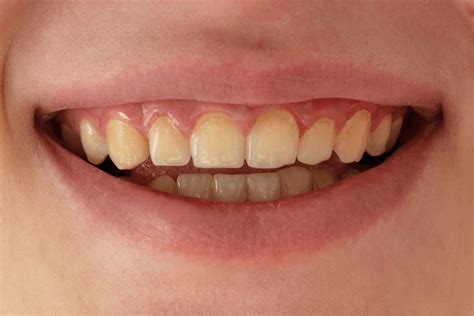 How To Get Rid Of Yellow Teeth Everything You Need To Know