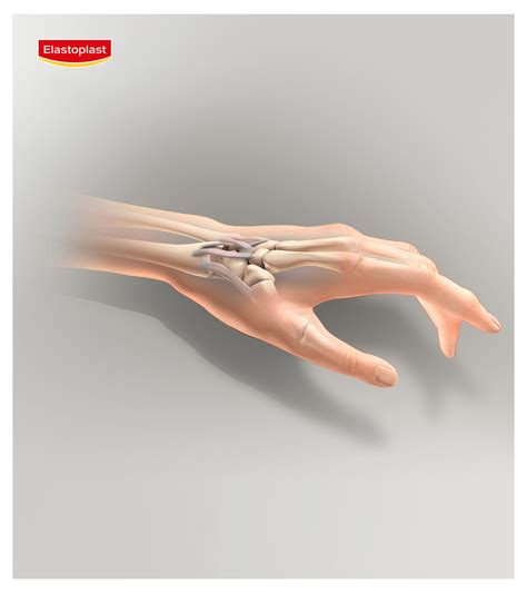 Dislocated Wrist Healing Time Elastoplast Uk