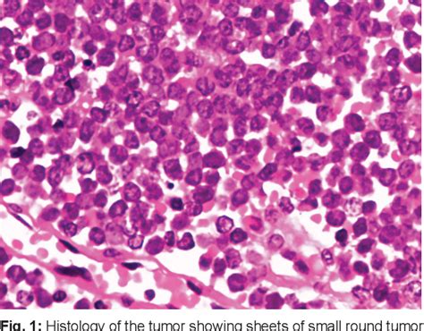 Figure 1 From A Rare Case Of Primary Spinal Primitive Neuroectodermal Tumor With Long Term