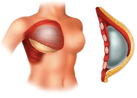 Prepectoral Implant Based Reconstruction Melbourne Vic