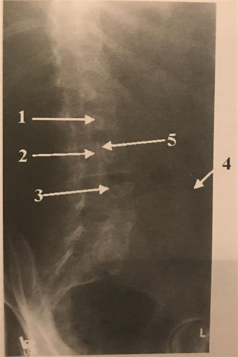 LPO Lumbar Spine Diagram Quizlet