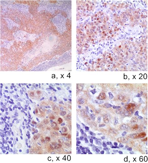 ihc expression of p16 protein in opscc showed at increasing