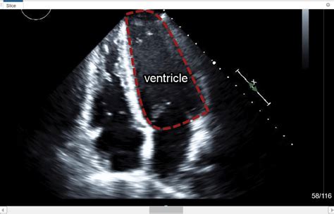 Label D Ultrasound Series Using Medical Image Labeler Matlab Simulink