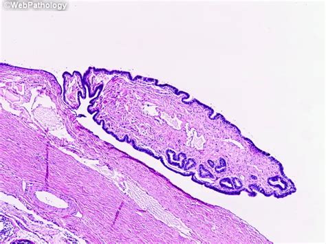 Appendix Testis