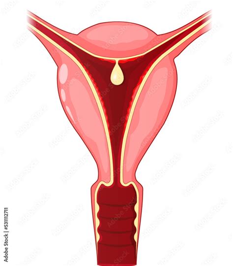 Uterine Polyp Human Uterus With Endometrial Polyp Stock Vector Adobe Stock