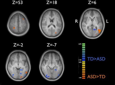 Uncorrected Comparison Map From The Autism Spectrum Experiment Download Scientific Diagram