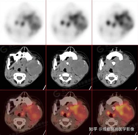 Pet Ct