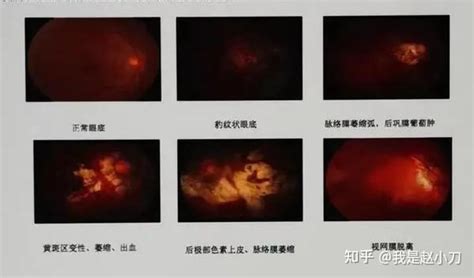 成年人能用哺光仪吗？来看一下这个病理性近视的案例 知乎