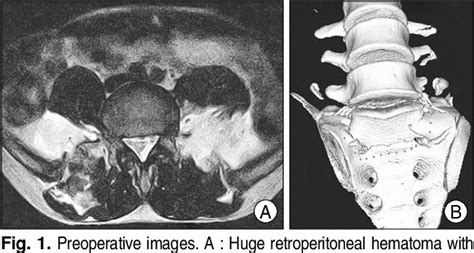 Figure 1 From Lumbo Sacro Pelvic Fixation Using Iliac Screws For The