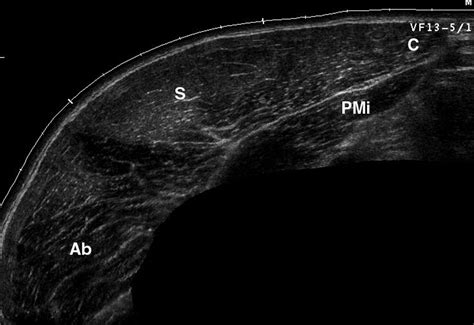 Sonographic Evaluation Of Injuries To The Pectoralis Muscles Ajr
