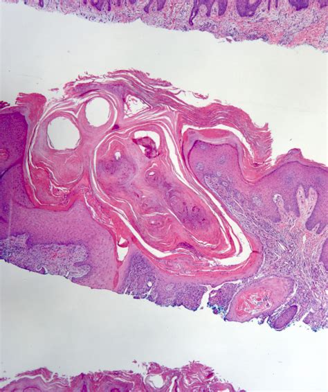 Keratoacanthoma Blog