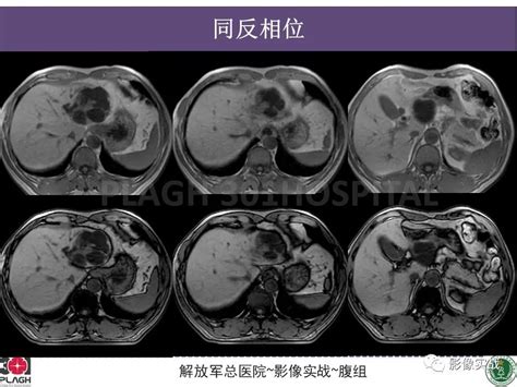 病例肝内胆管囊腺癌1例MR 影像PPT