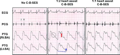 Representative Plethysmography Waveform Charts During C B Ses With