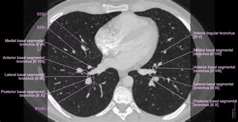 Computed Tomography Scan Thorax Figure 1 Chest X Ray