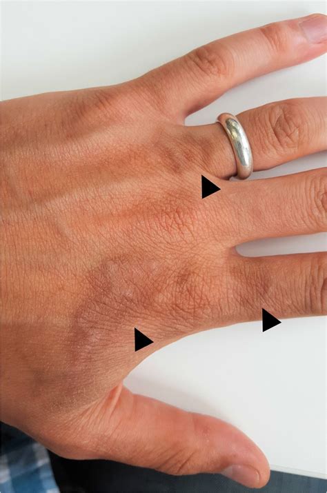 Lime Induced Phytophotodermatitis Pmc