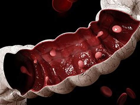 Ai Algorithm May Differentiate Polyps On Ct Colonography