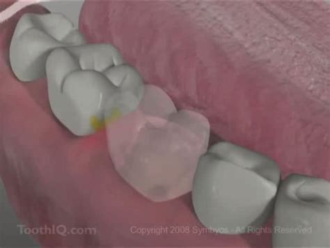 The Only Effective Way To Clean Between Your Teeth Is To Floss Properly Every Day