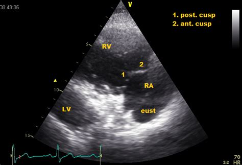 Aortic Valve Cusps Echo