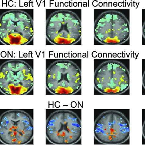 Homotopic Primary Visual Cortex Functional Connectivity Is Correlated