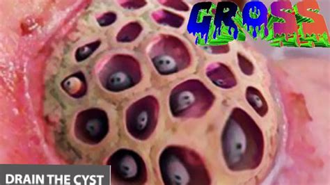 Gross Skin Conditions