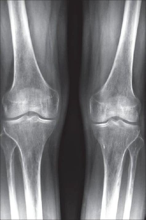 Severe Osteoporosis X Ray
