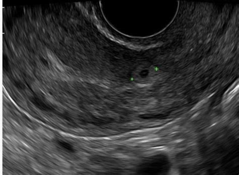 Cesarean Scar Pregnancy