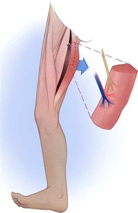 Gracilis Muscle