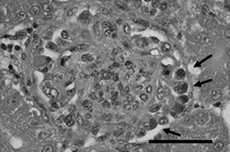 Mis Arrows In The Cytoplasm Of Podocytes Of The Glomerulus Case 3 Download Scientific