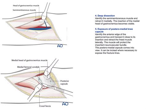 Proximal Tibia Approach Pptx
