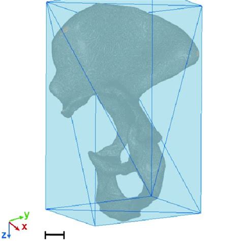 Pelvis With Acetabulum Defect Paprosky Iiia And A Minimal Bounding