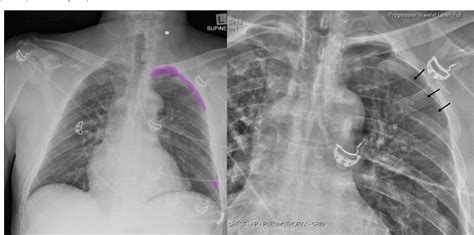 Figure 4 From Diagnostic Accuracy Of A Commercially Available Deep Learning Algorithm In Supine