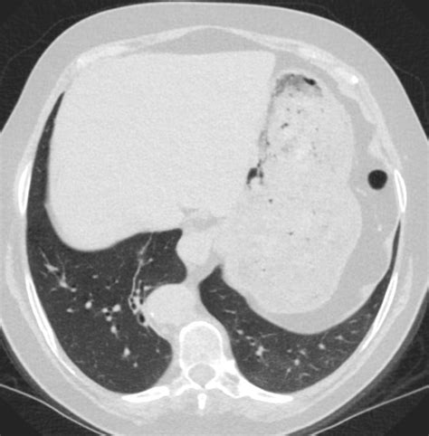 Atelectasis Compressive The Common Vein