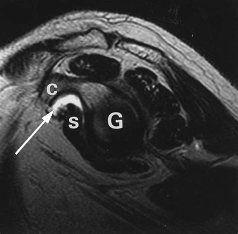 Scapula Bursitis Mri At Brock Moore Blog