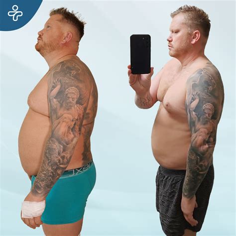 Gastric Sleeve Results Without Surgery