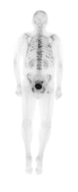 Case 3 Of A 67 Year Old Man Anterior And Posterior Bone Scan And Ct Download Scientific