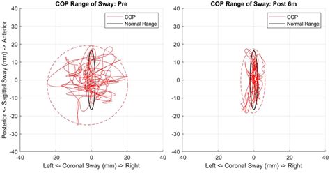 Figure 1 From Effect Of Sacroiliac Fusion On Gait Standing Balance And Pelvic Mobility For