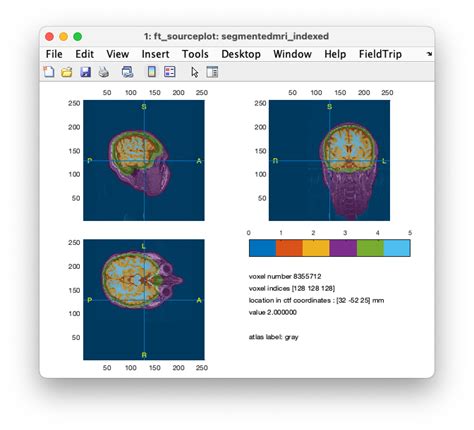 Creating A Fem Volume Conduction Model Of The Head For Source Reconstruction Of Eeg Data