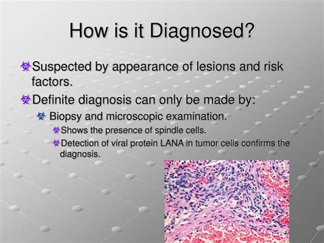 Ppt Kaposis Sarcoma Powerpoint Presentation Free Download Id5878942