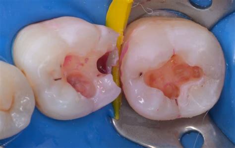 A Recipe For Class Ii Composite Restoration Myzerodonto