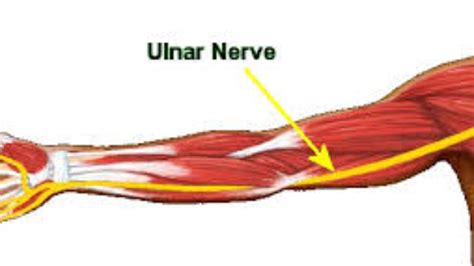 How To Treat Ulnar Nerve Entrapment At The Elbow At Ted Joan Blog