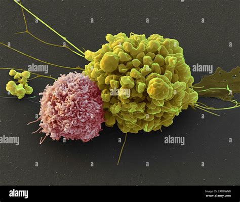 Coloured Scanning Electron Micrograph Sem Of Ependymoma Cell Yellow