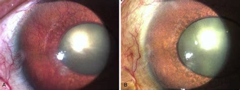 Neovascularization Of Iris