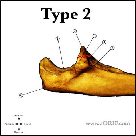 Coronoid Fracture Orif Eorif