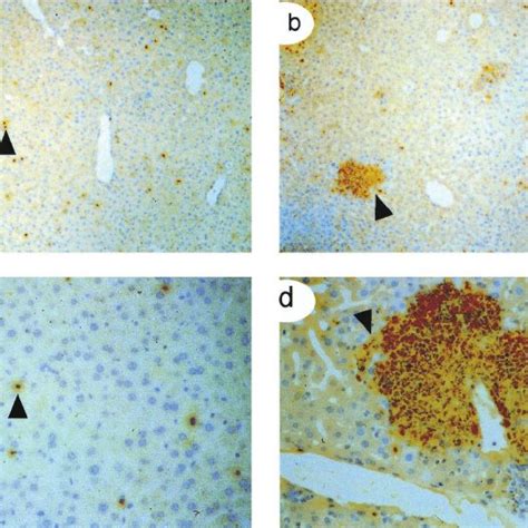 Massive Infiltration Of Neutrophils Leading To Microabscess Formation