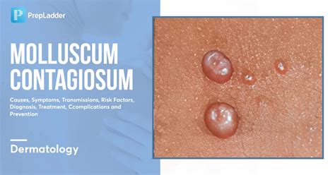 Molluscum Contagiosum Symptoms Molluscum Contagiosum Water Warts